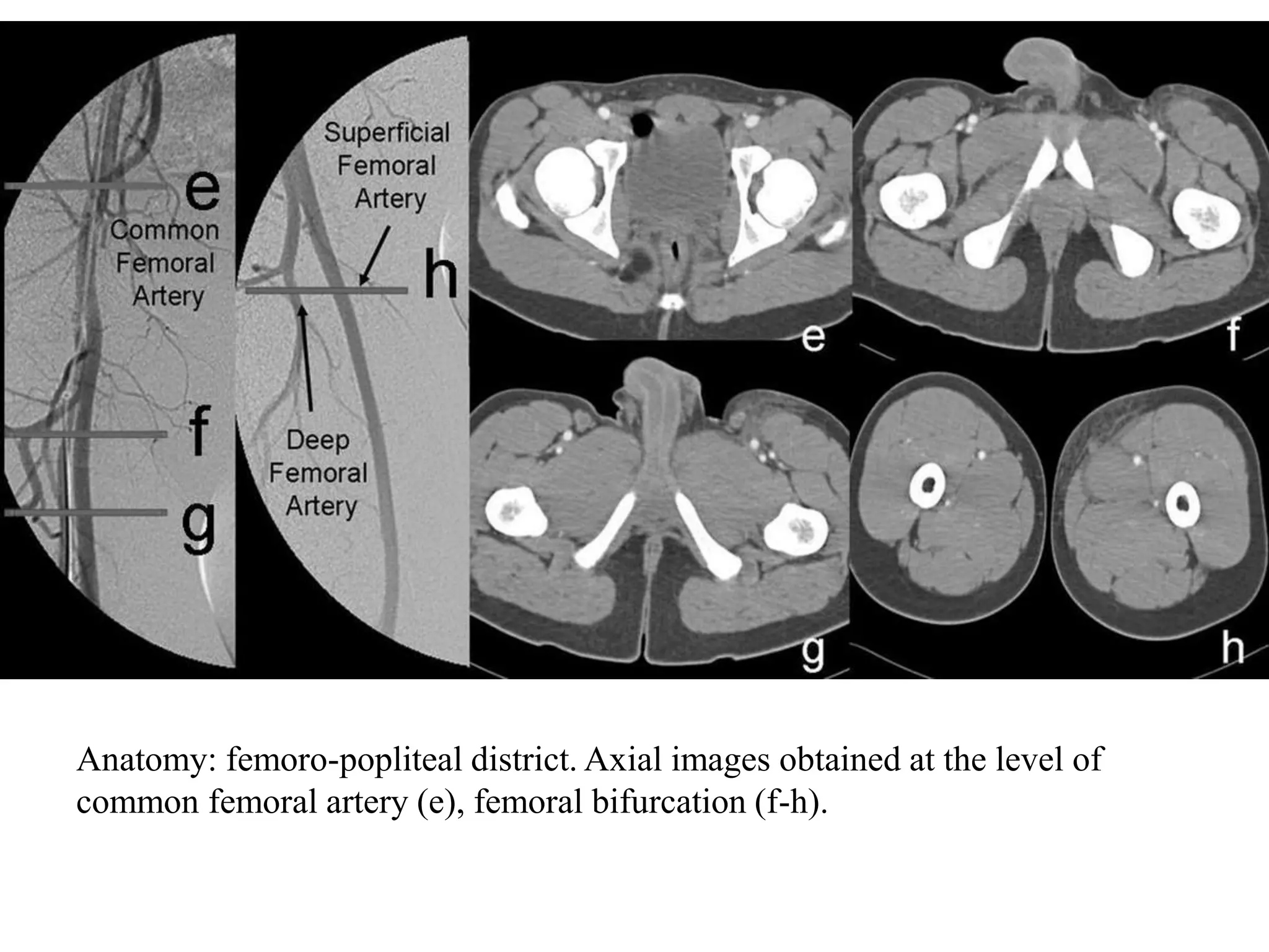CT Angiography Lower Limb | PPTX