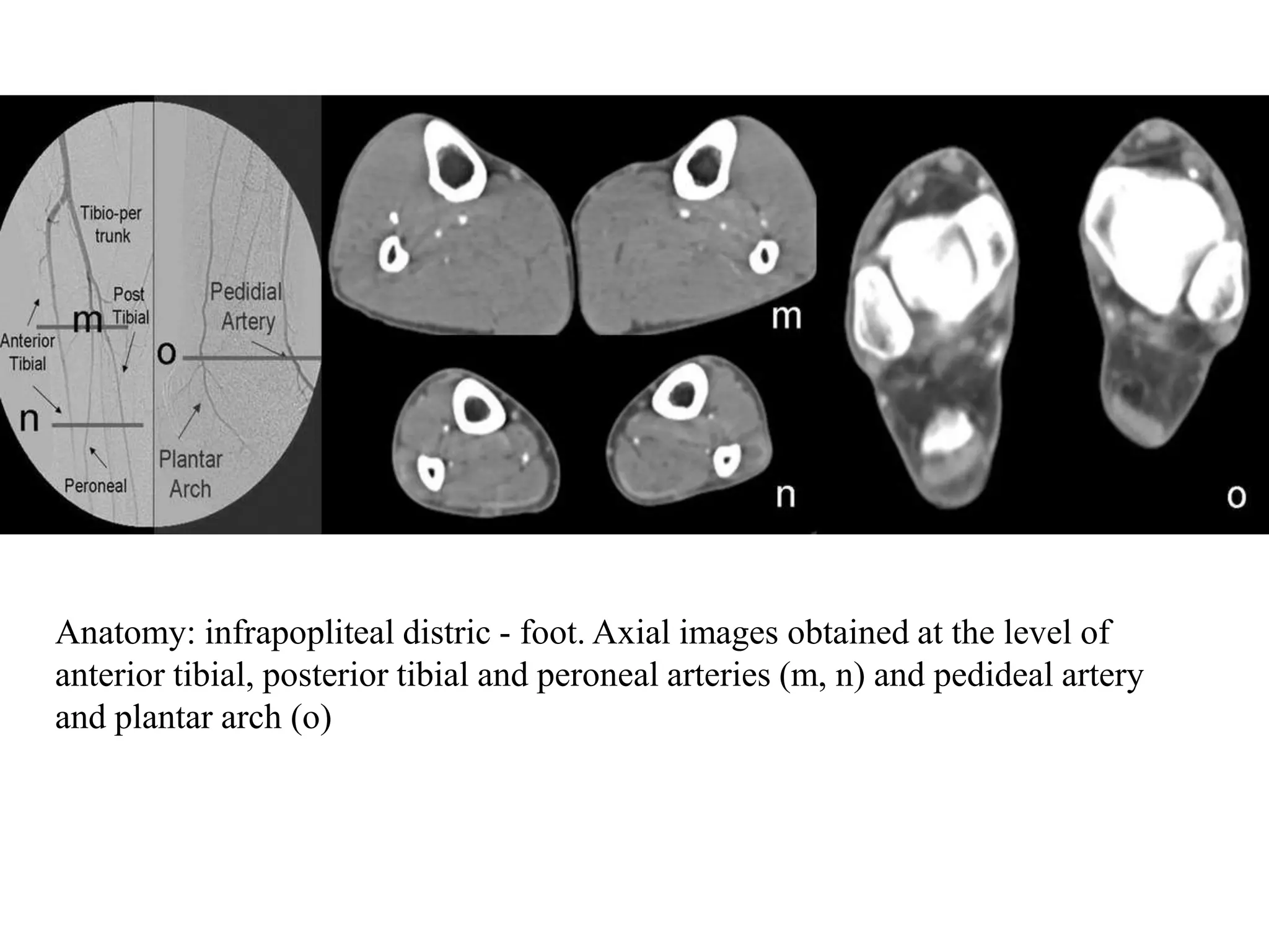 CT Angiography Lower Limb | PPTX