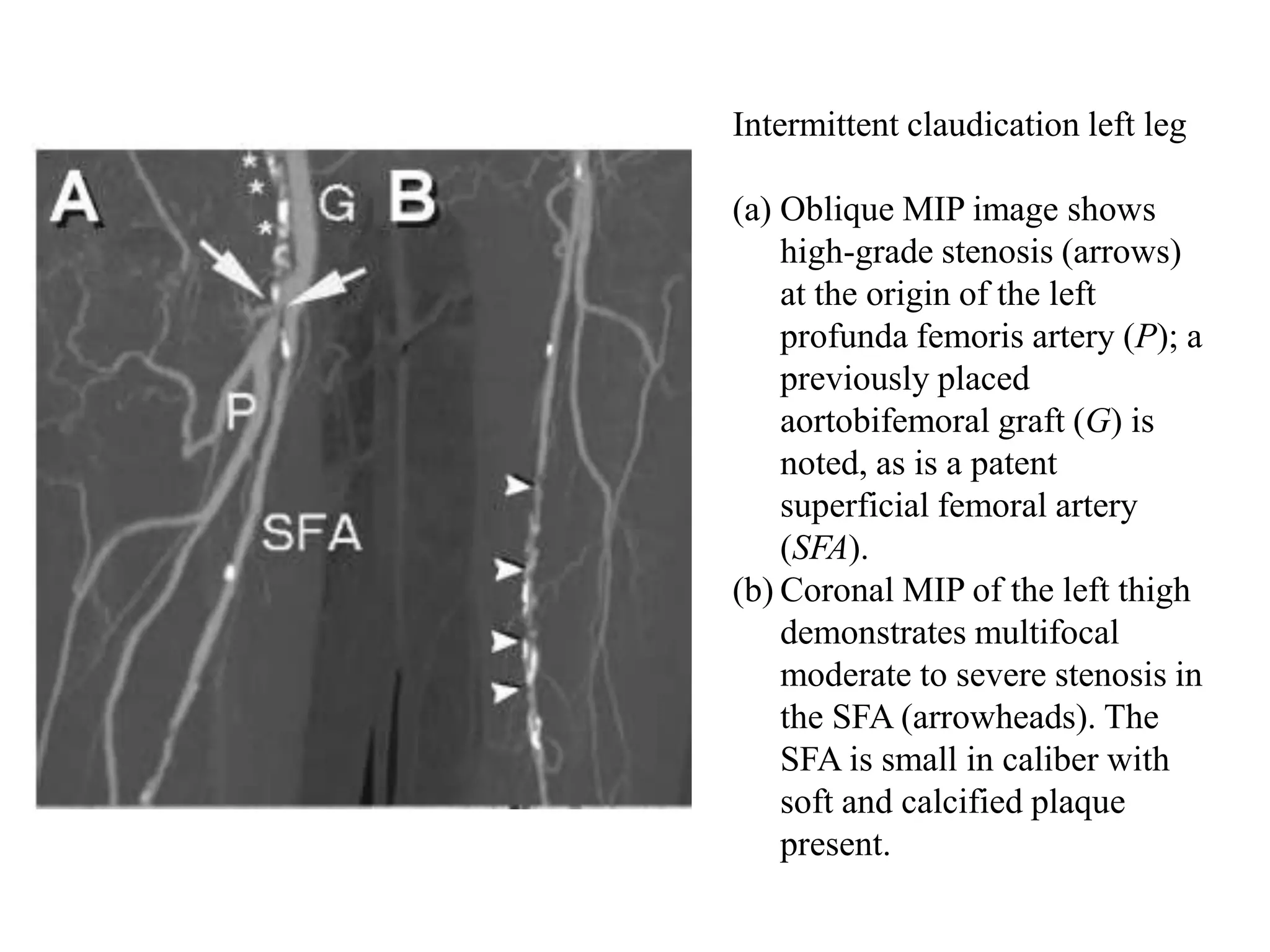 CT Angiography Lower Limb | PPTX