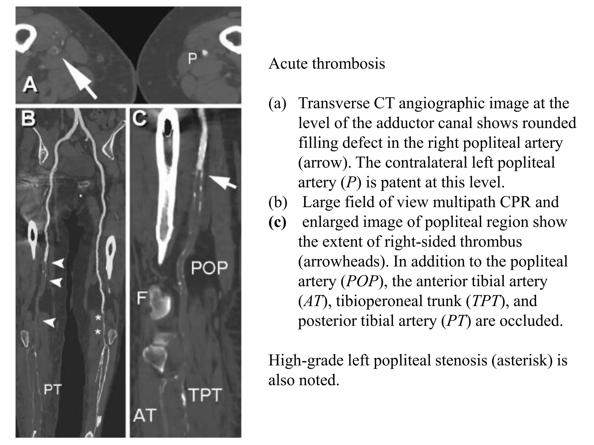 CT Angiography Lower Limb | PPTX
