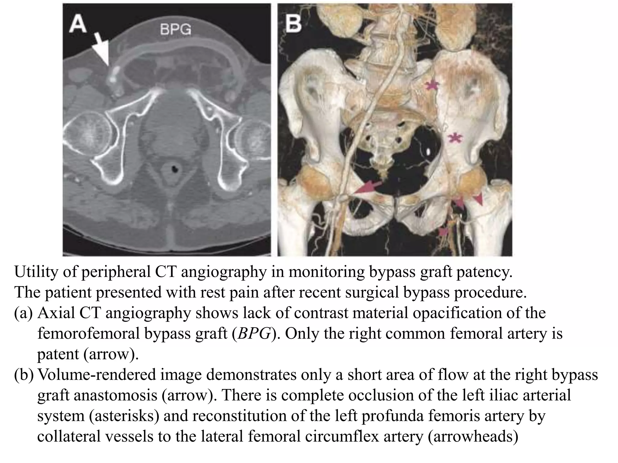 CT Angiography Lower Limb | PPTX