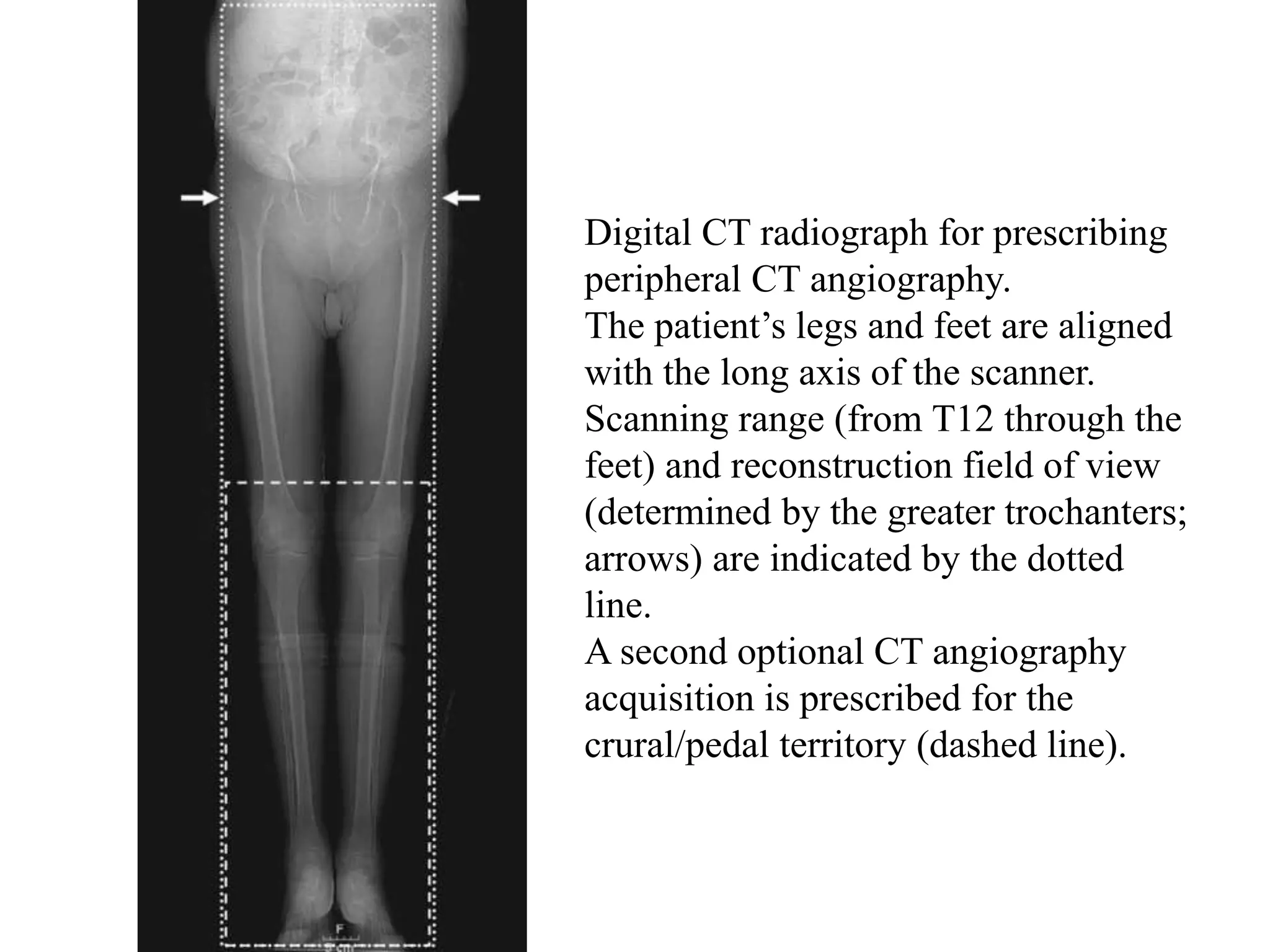 CT Angiography Lower Limb | PPTX