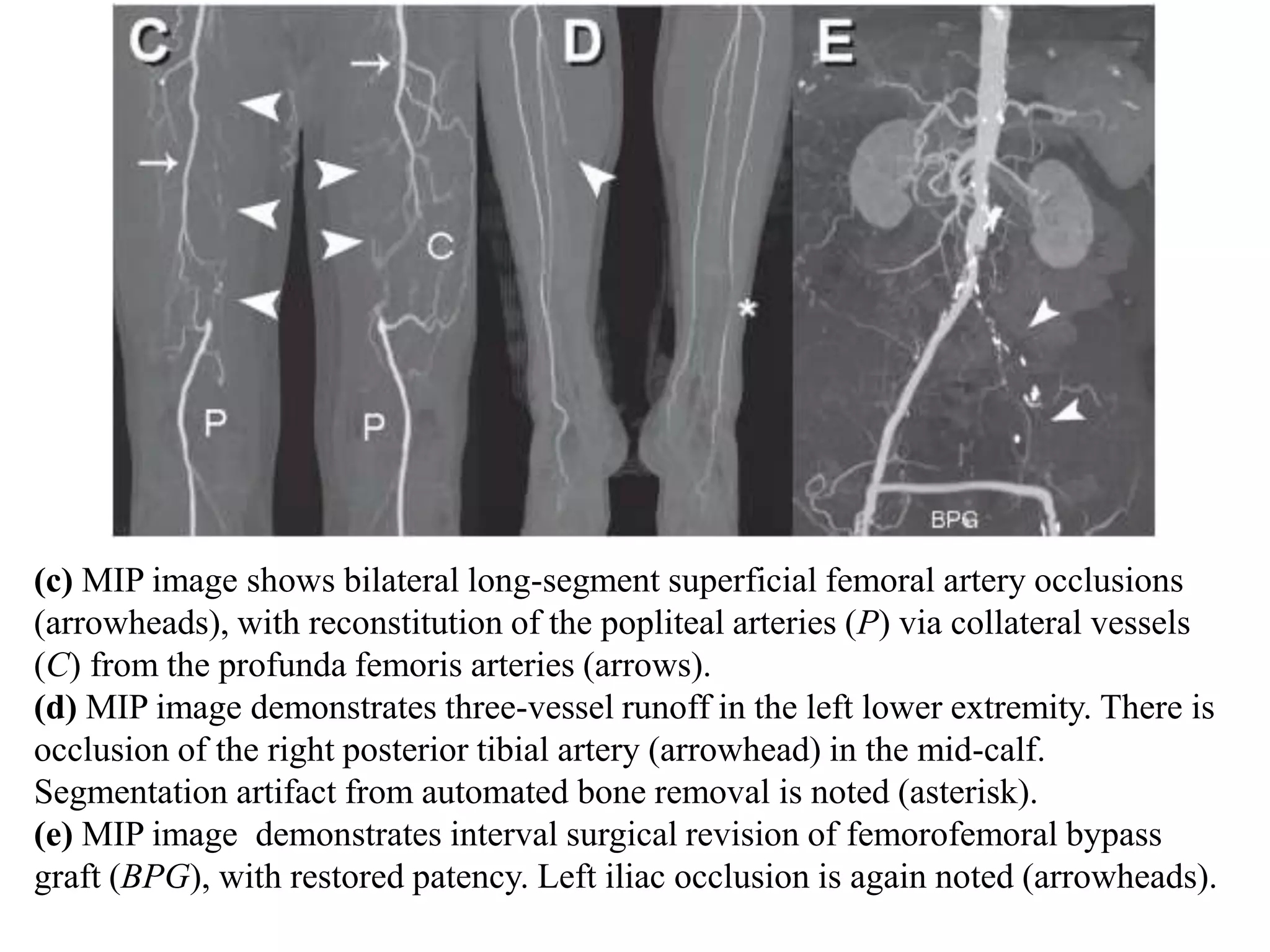 CT Angiography Lower Limb | PPTX