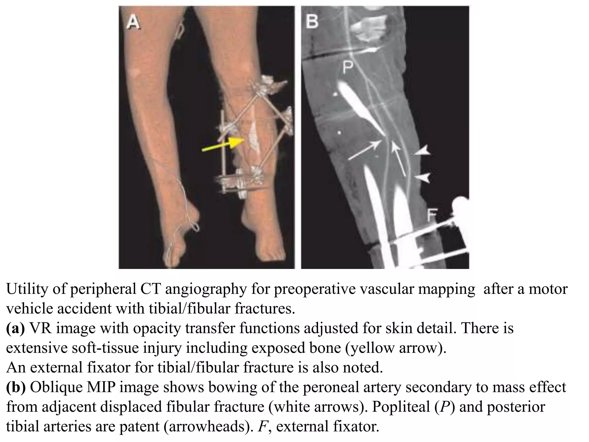 CT Angiography Lower Limb | PPTX