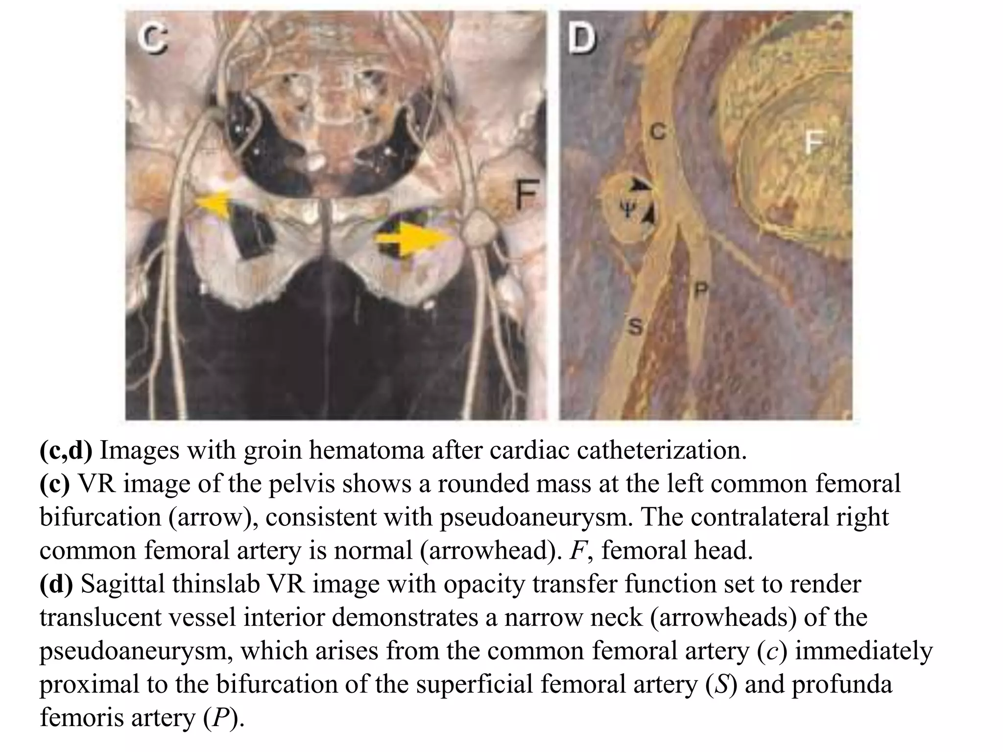 CT Angiography Lower Limb | PPTX