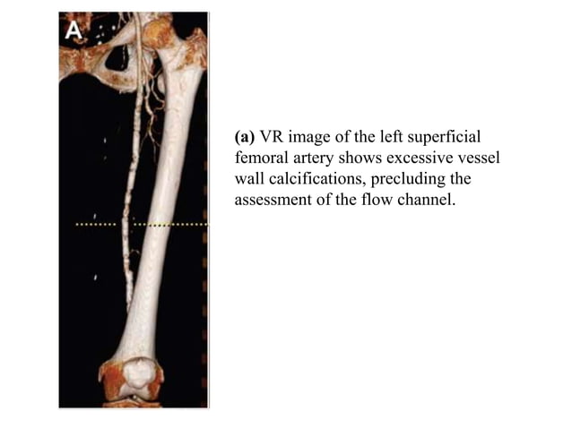 CT Angiography Lower Limb | PPTX