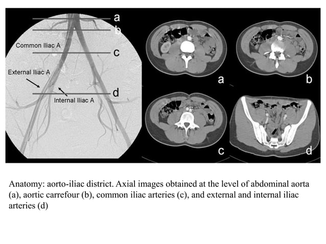 CT Angiography Lower Limb | PPTX