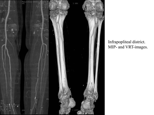 CT Angiography Lower Limb | PPTX