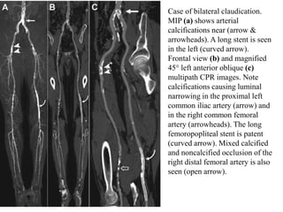 CT Angiography Lower Limb | PPTX