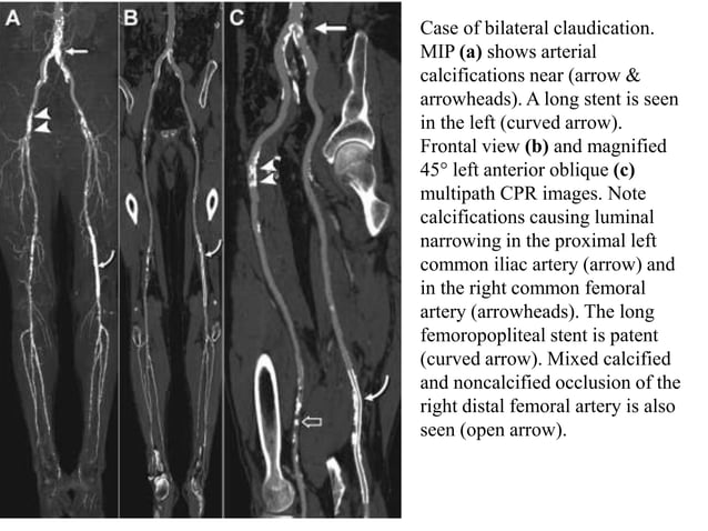 CT Angiography Lower Limb | PPTX