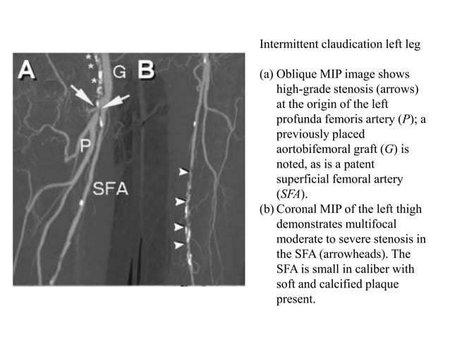CT Angiography Lower Limb | PPTX