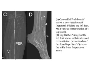 CT Angiography Lower Limb | PPTX