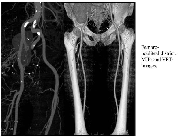 CT Angiography Lower Limb