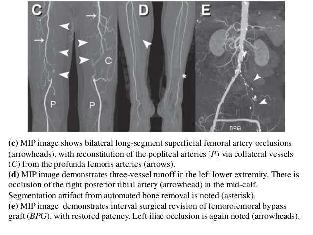 CT Angiography Lower Limb