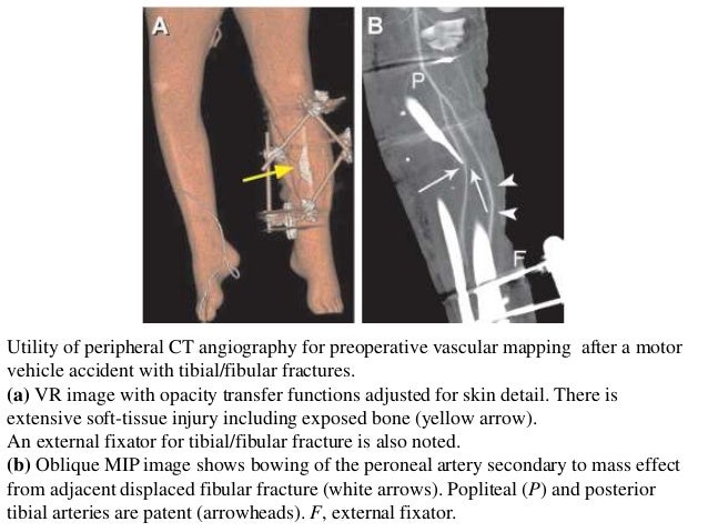 CT Angiography Lower Limb