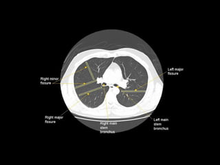 CT Anatomy | PPT