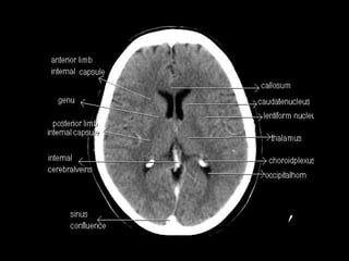 Heart Ct Scan Labeled