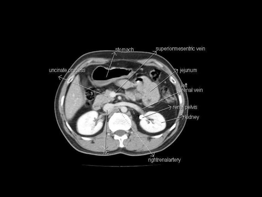 CT Anatomy