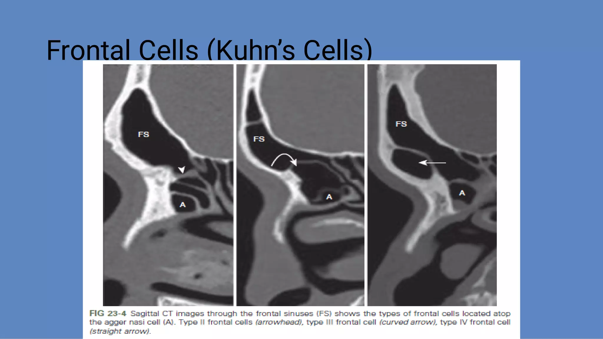 Ct anatomy of paranasal sinuses( PNS) pk.pdf ppt | PDF