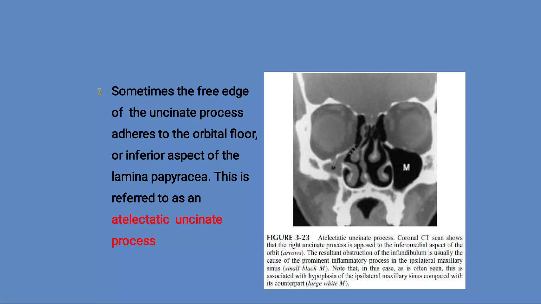 Ct Pns Anatomy Computed Tomography Of The Face And Paranasal Sinuses: