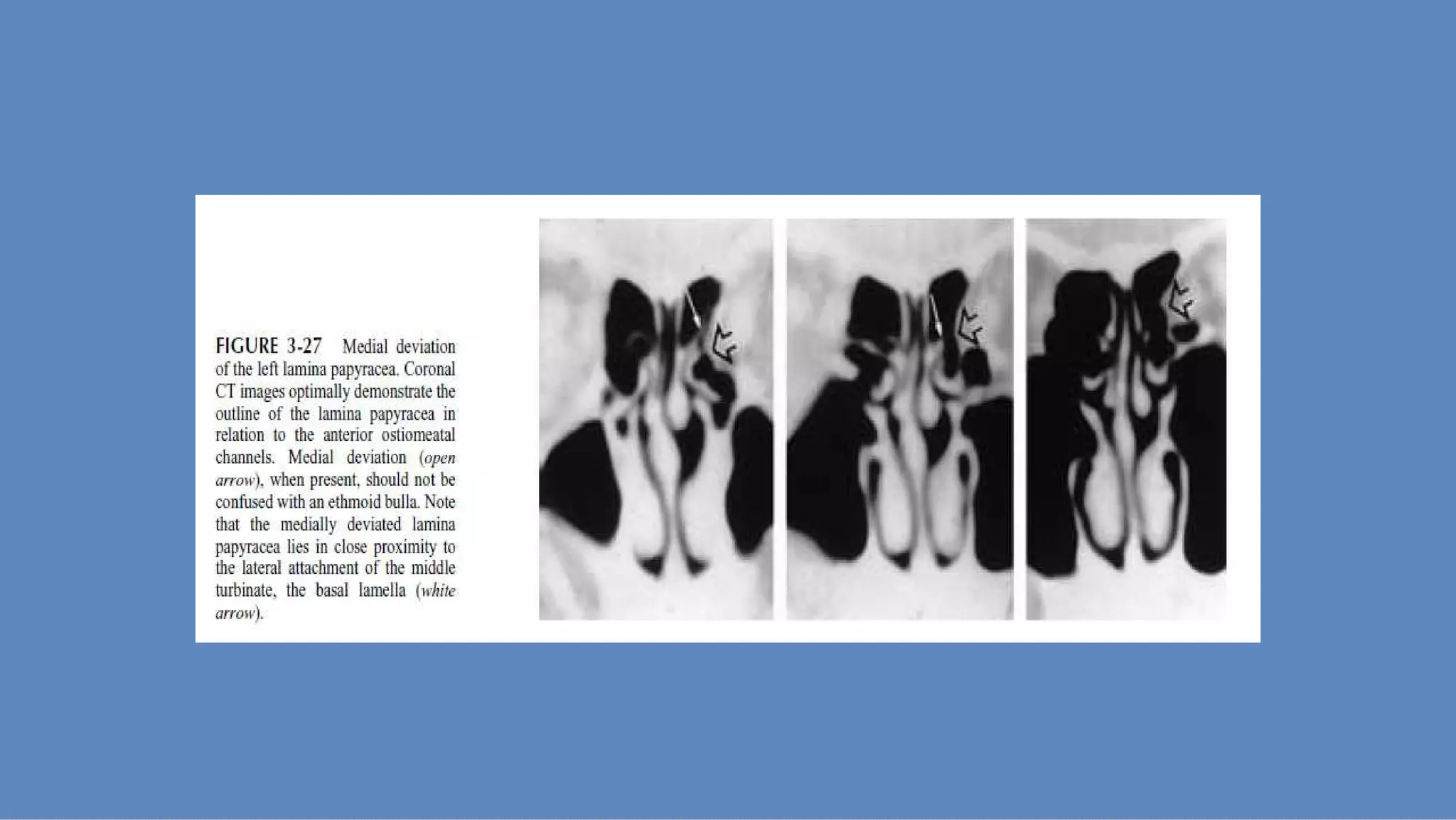 Ct anatomy of paranasal sinuses( PNS) pk.pdf ppt | PDF