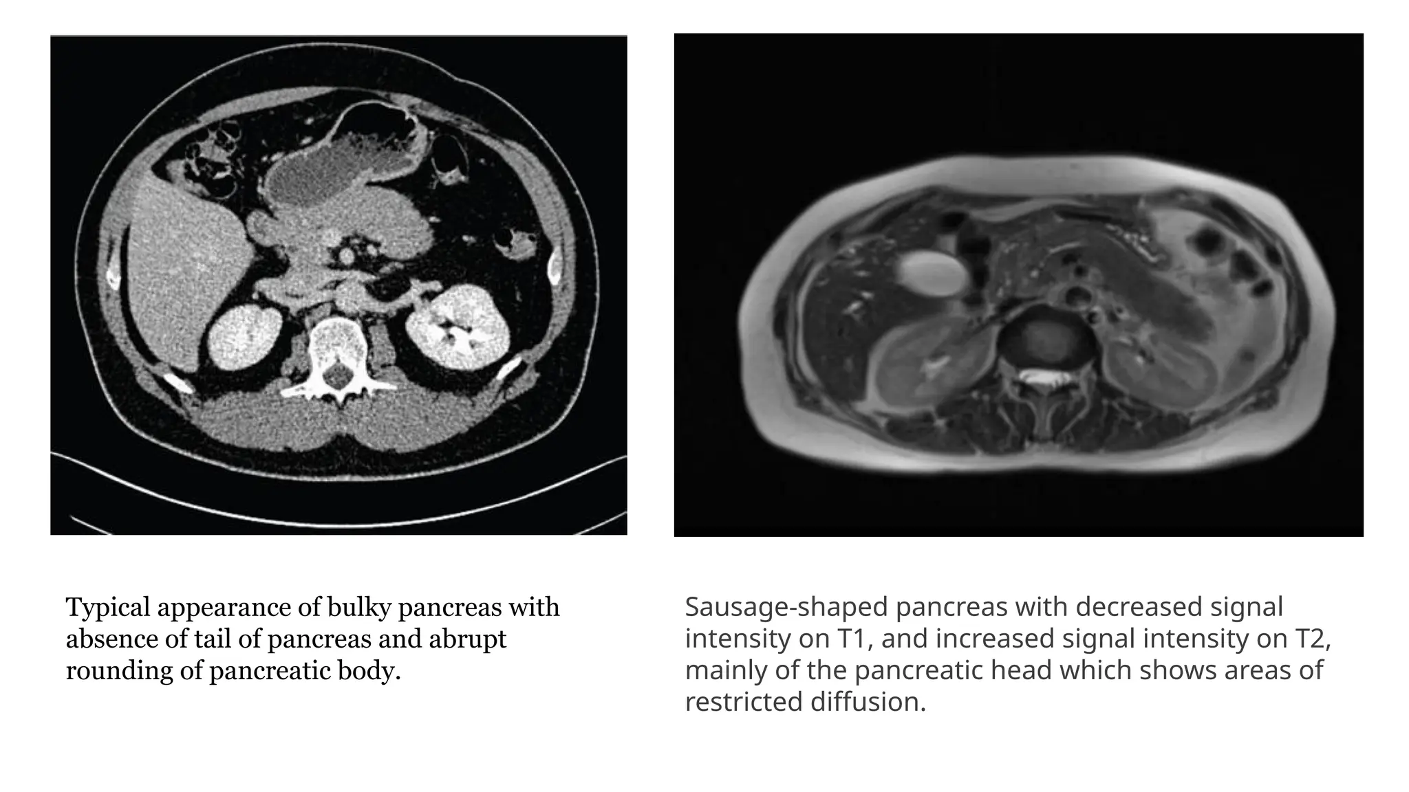 CT AND MRCP FINDINGS OF ACUTE AND CHRONIC.pptx