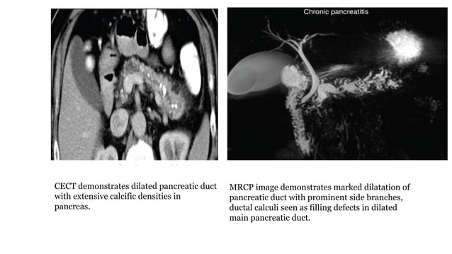 CT AND MRCP FINDINGS OF ACUTE AND CHRONIC.pptx