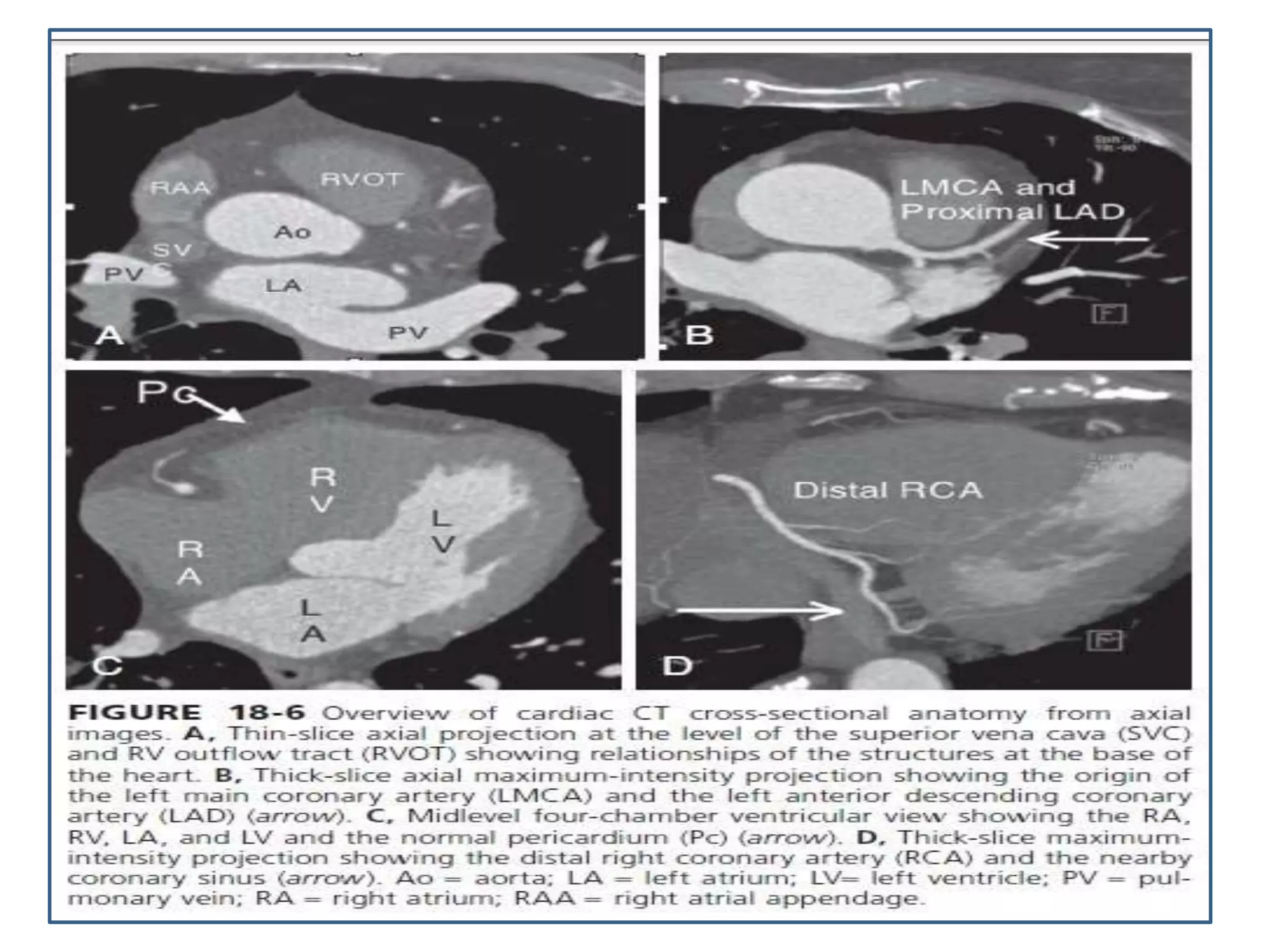 Ct angio in cardiology | PPTX