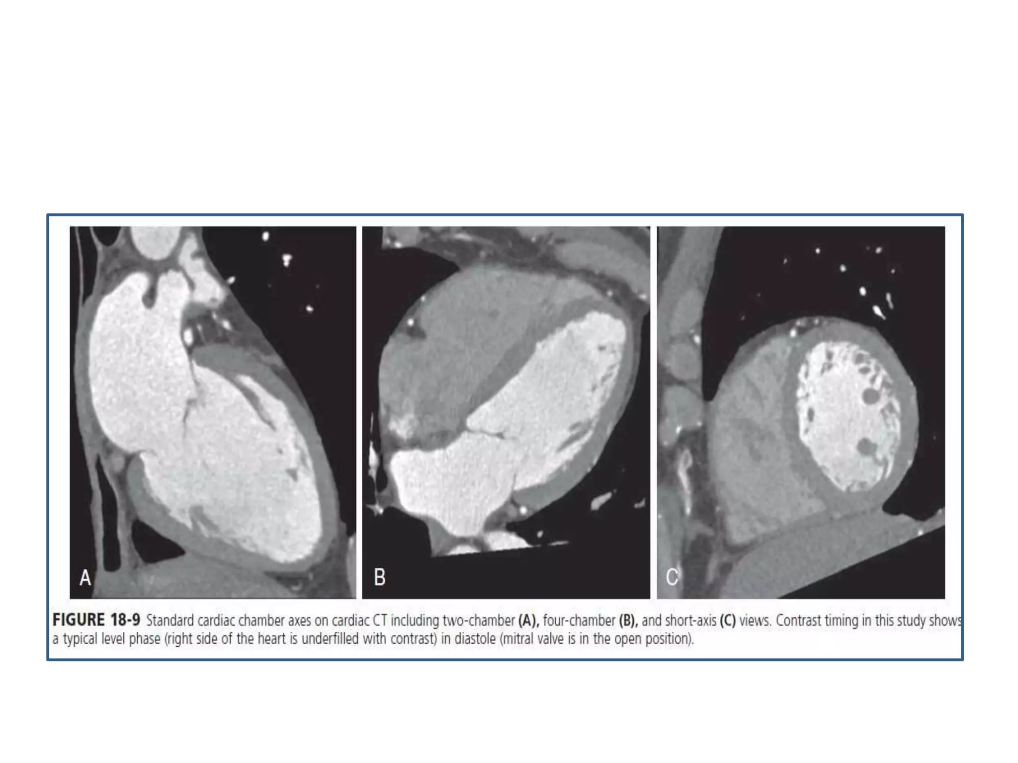 Ct angio in cardiology | PPTX
