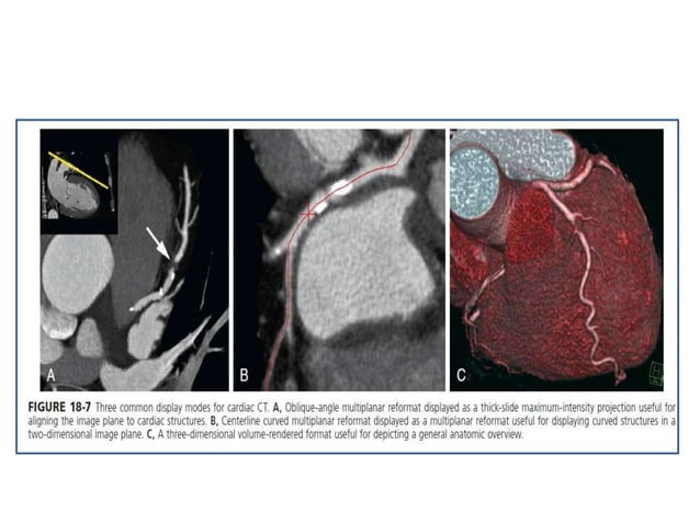 Ct angio in cardiology | PPT