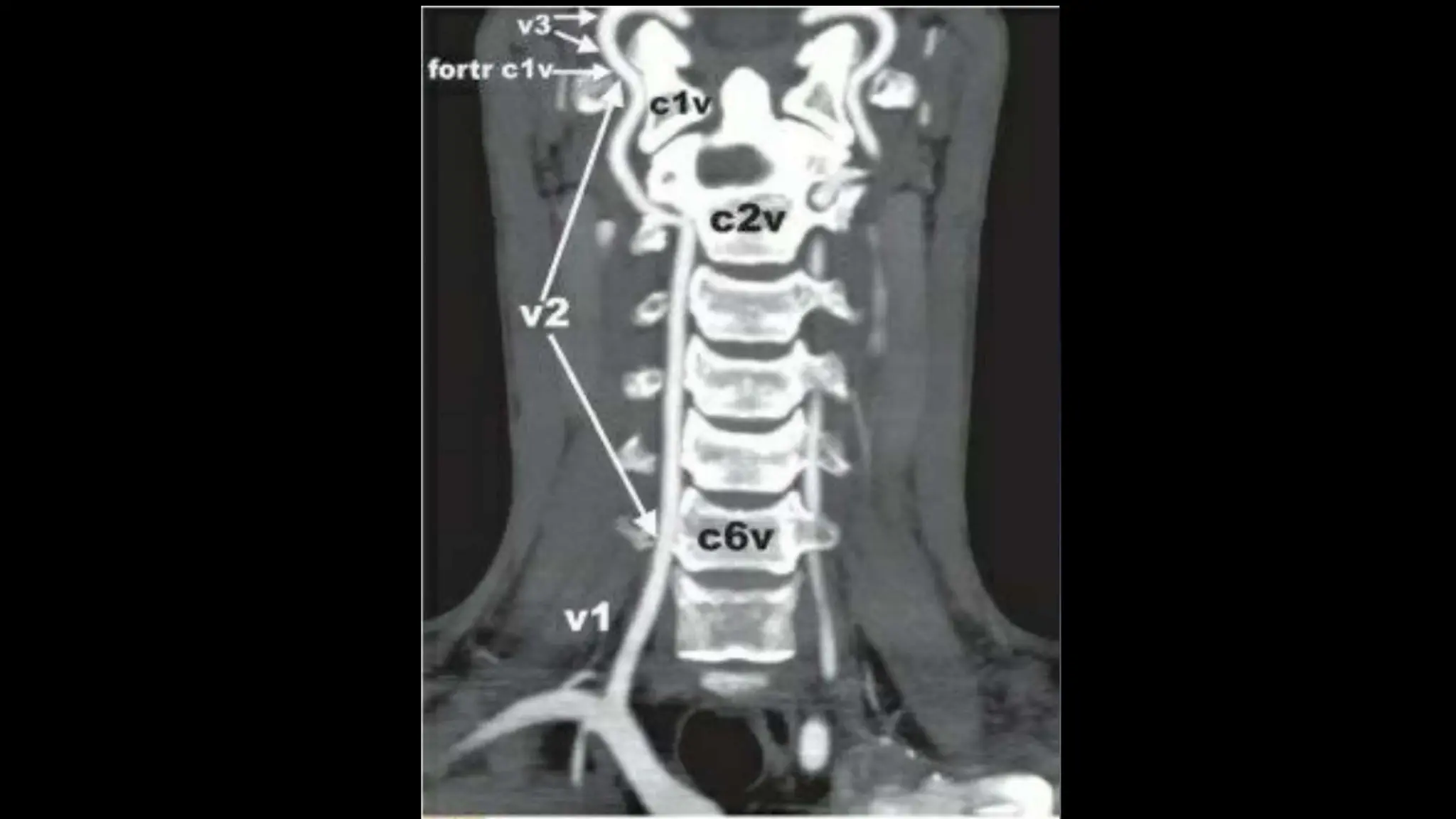 CT ANGIO 2.pptx by sms medical college jaipur | PPT