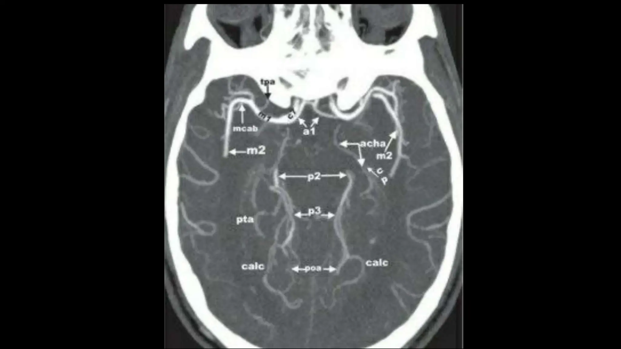 CT ANGIO 2.pptx by sms medical college jaipur | PPT
