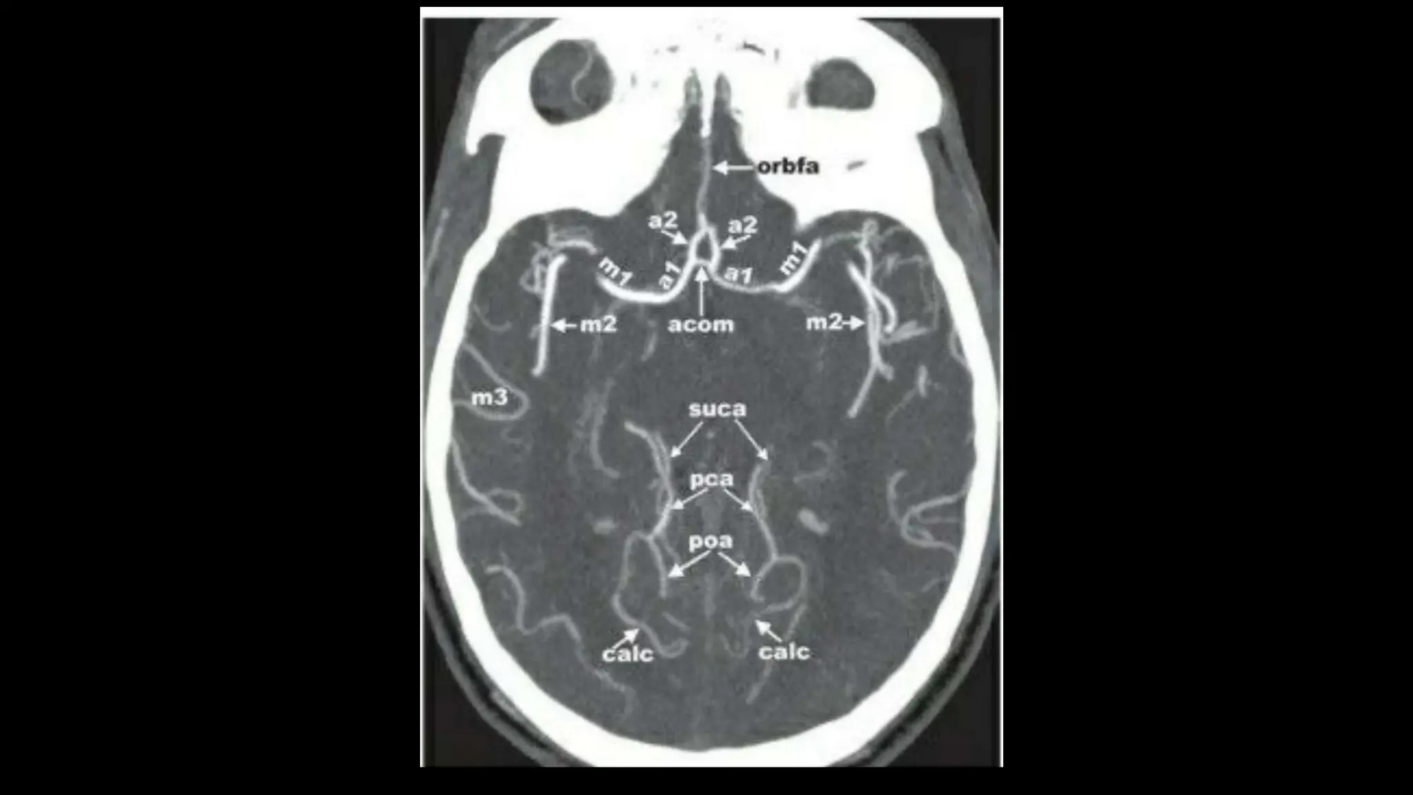 CT ANGIO 2.pptx by sms medical college jaipur | PPT
