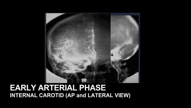 CT ANGIO 2.pptx by sms medical college jaipur | PPT