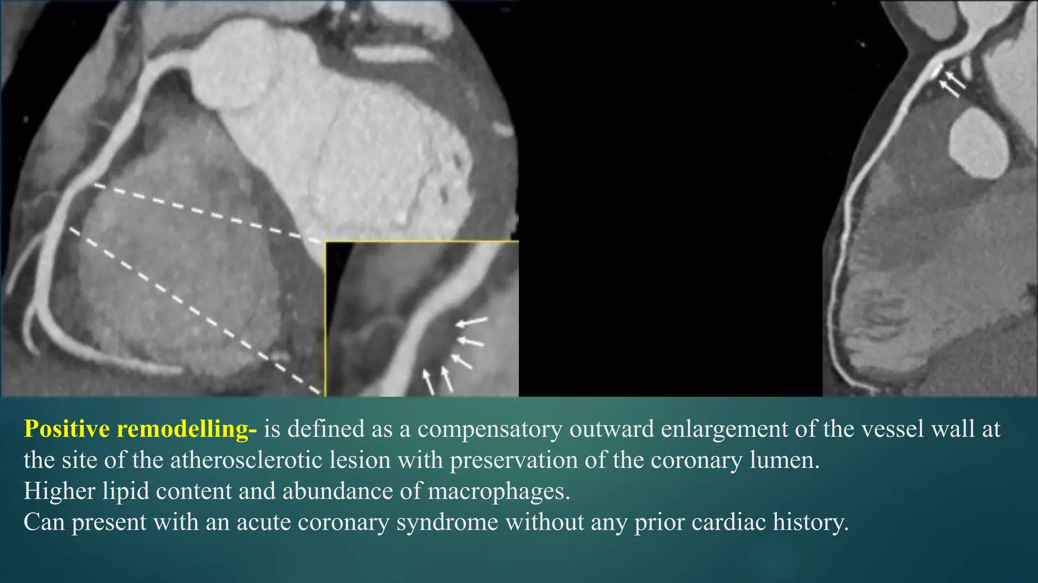 CT angiography.pptx