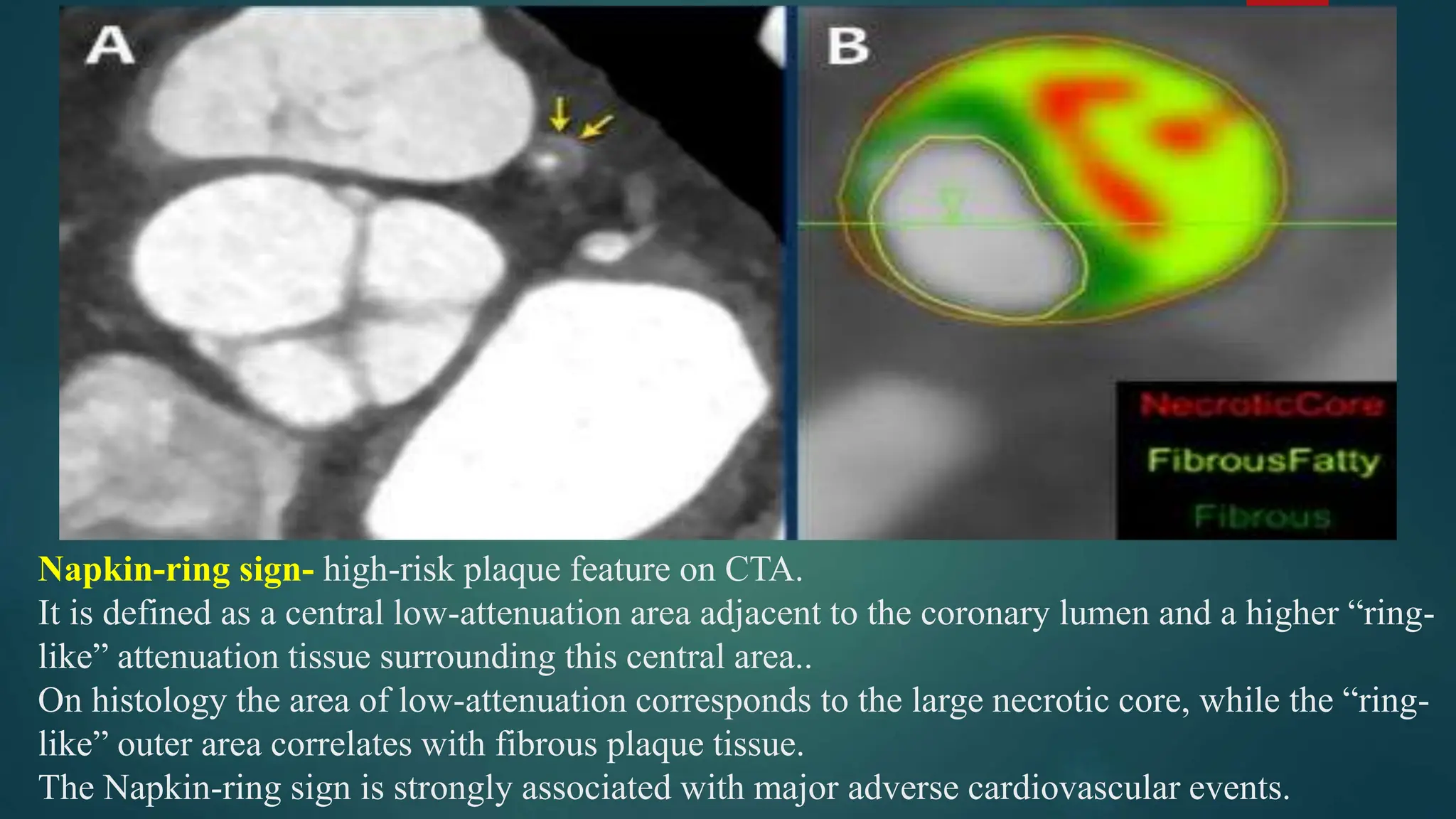 CT angiography.pptx