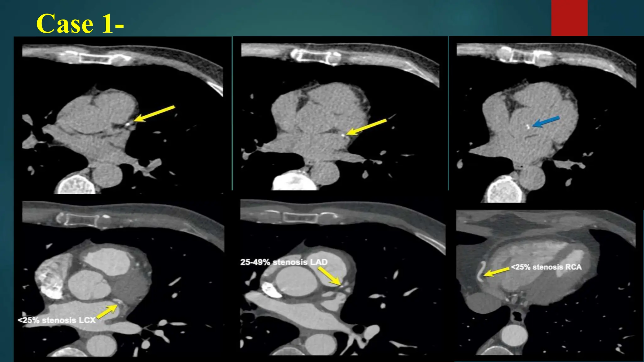 CT angiography.pptx