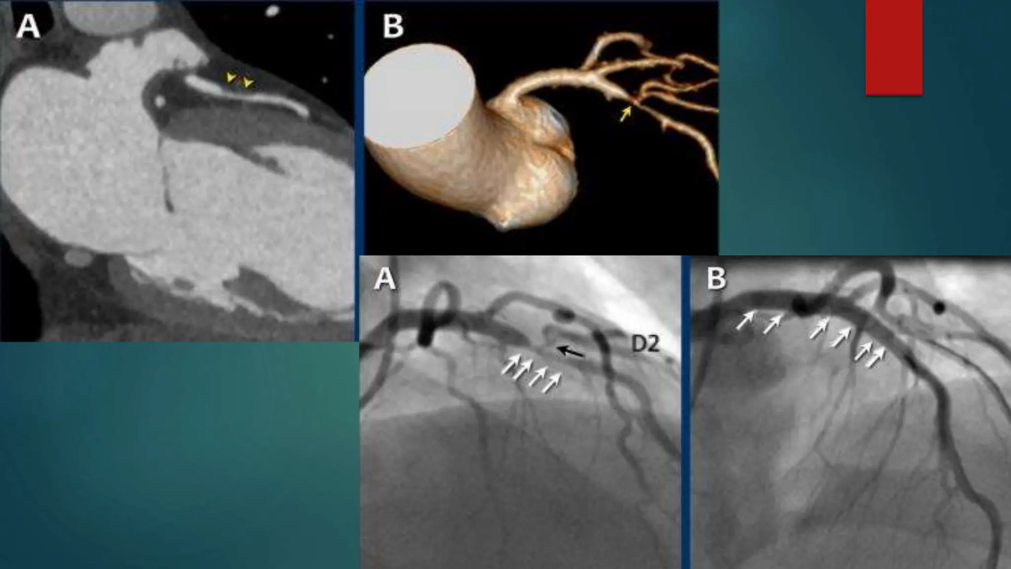 CT angiography.pptx