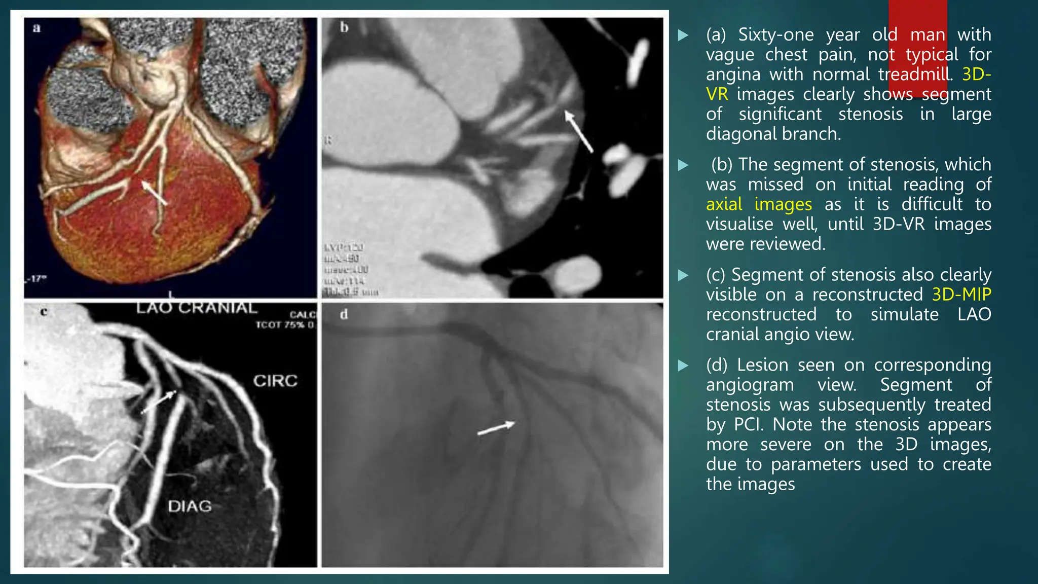 CT angiography.pptx
