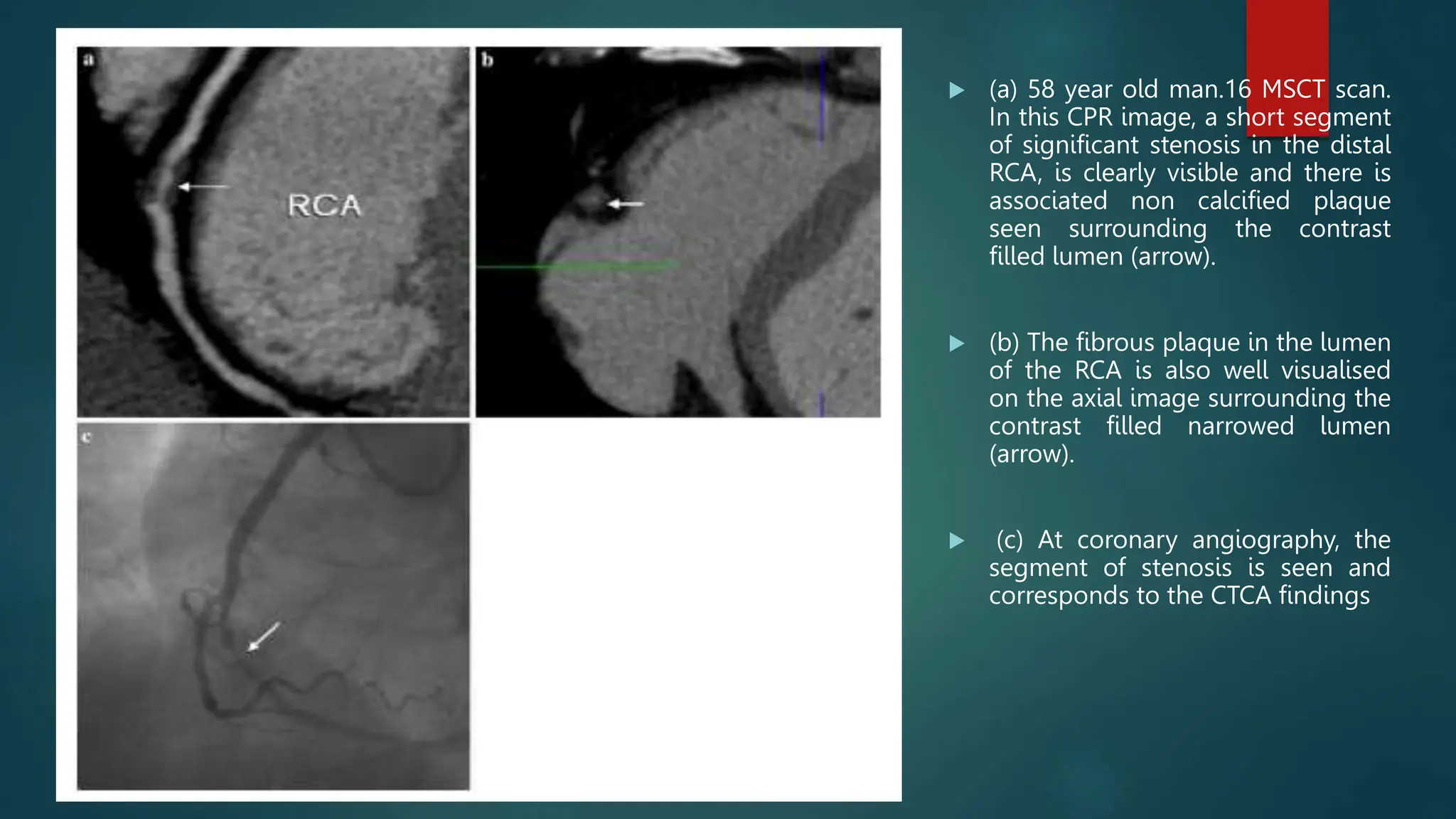 CT angiography.pptx