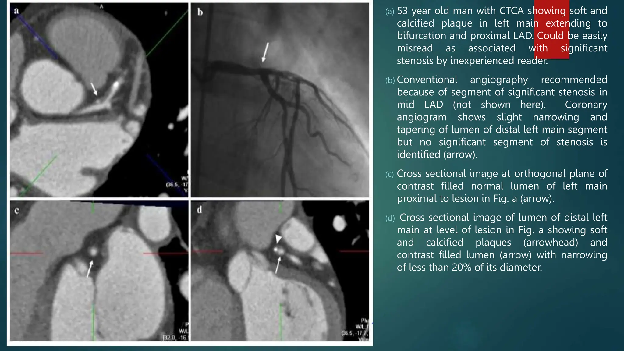 CT angiography.pptx