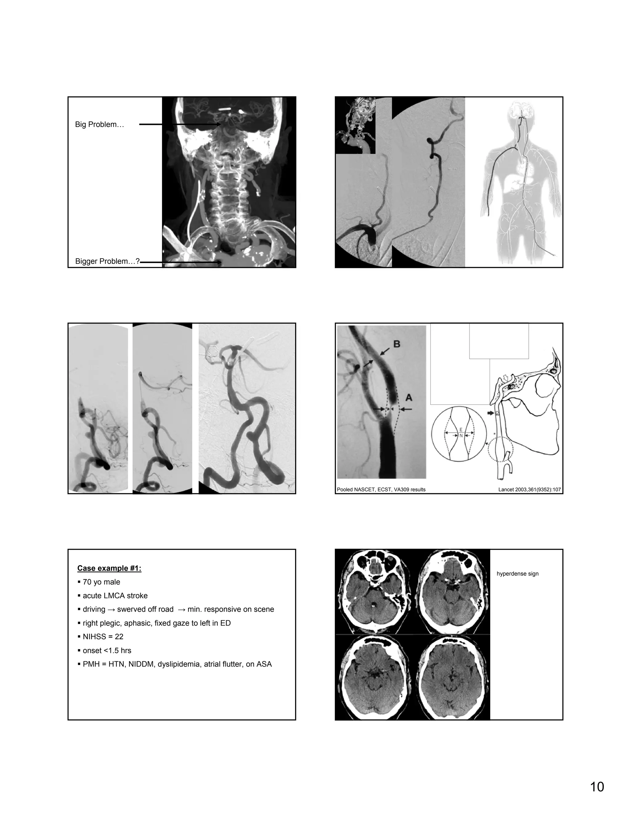 CT Angiography & CT Perfusion in Management of Acute Stroke | PDF