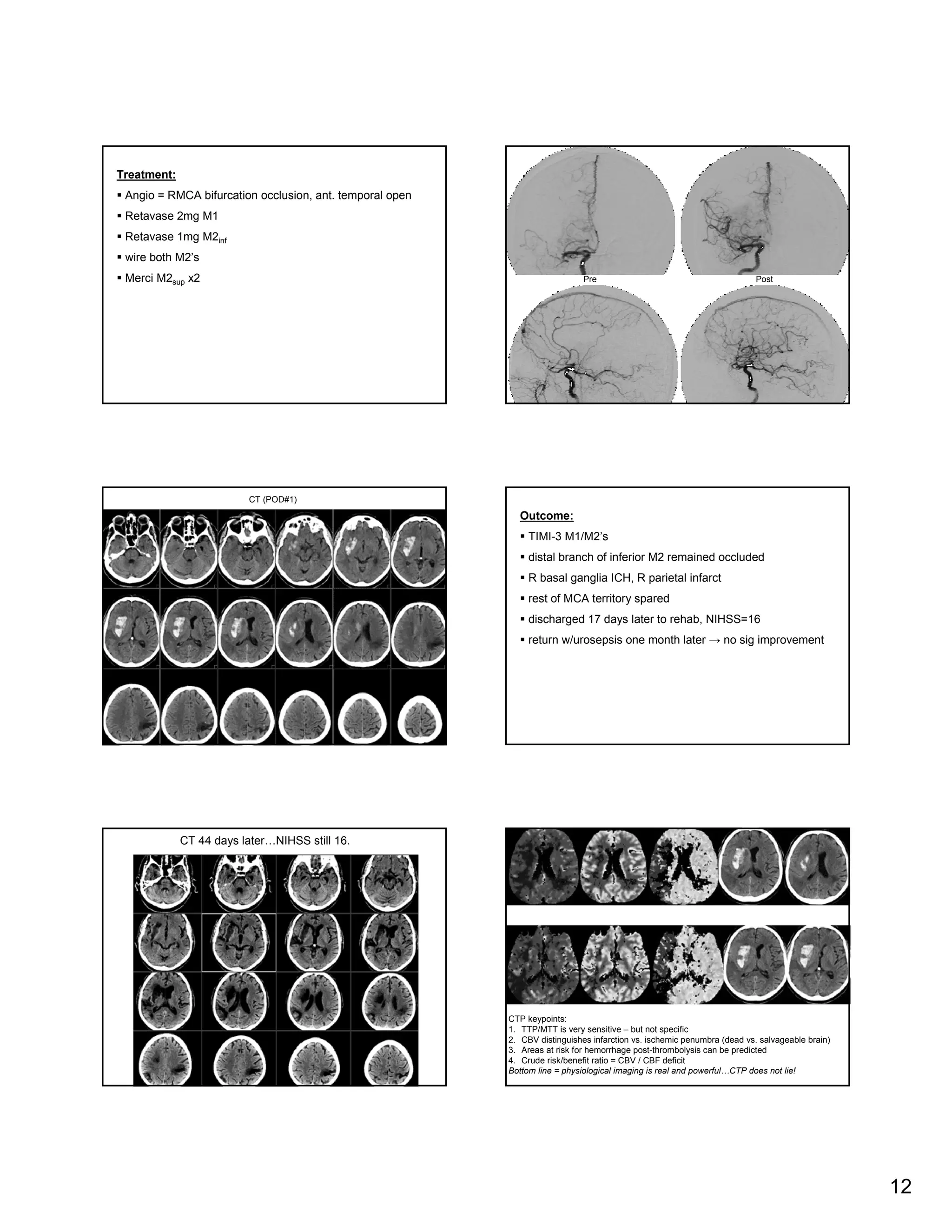 CT Angiography & CT Perfusion in Management of Acute Stroke | PDF