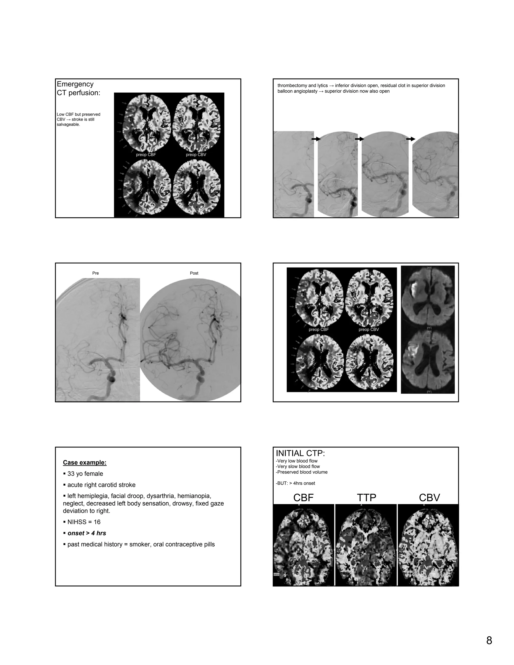 CT Angiography & CT Perfusion in Management of Acute Stroke | PDF