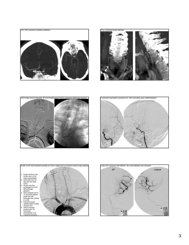 CT Angiography & CT Perfusion in Management of Acute Stroke | PDF