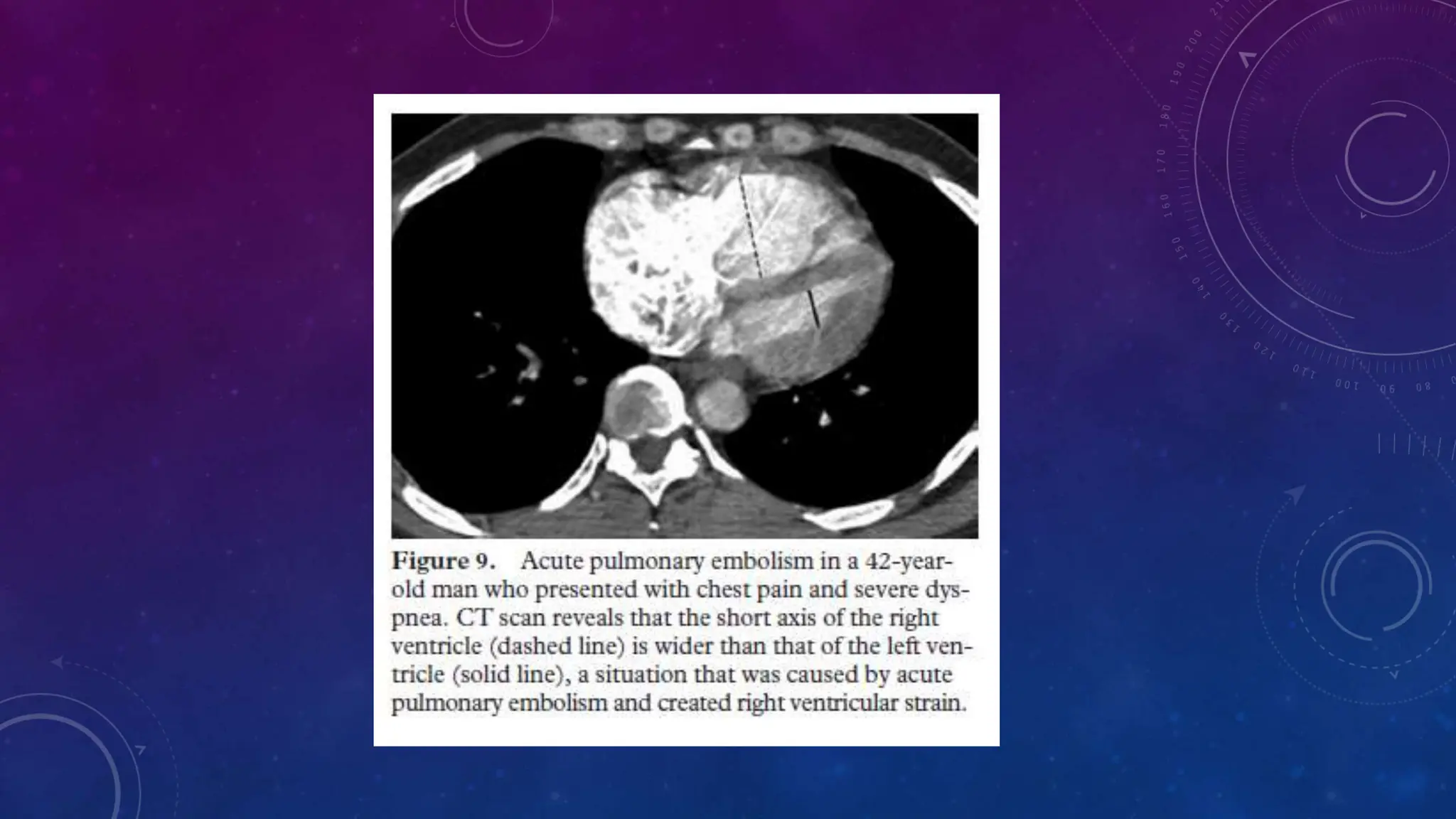 CT AnGIOGRAPHY of pulmonary embolism.pptx