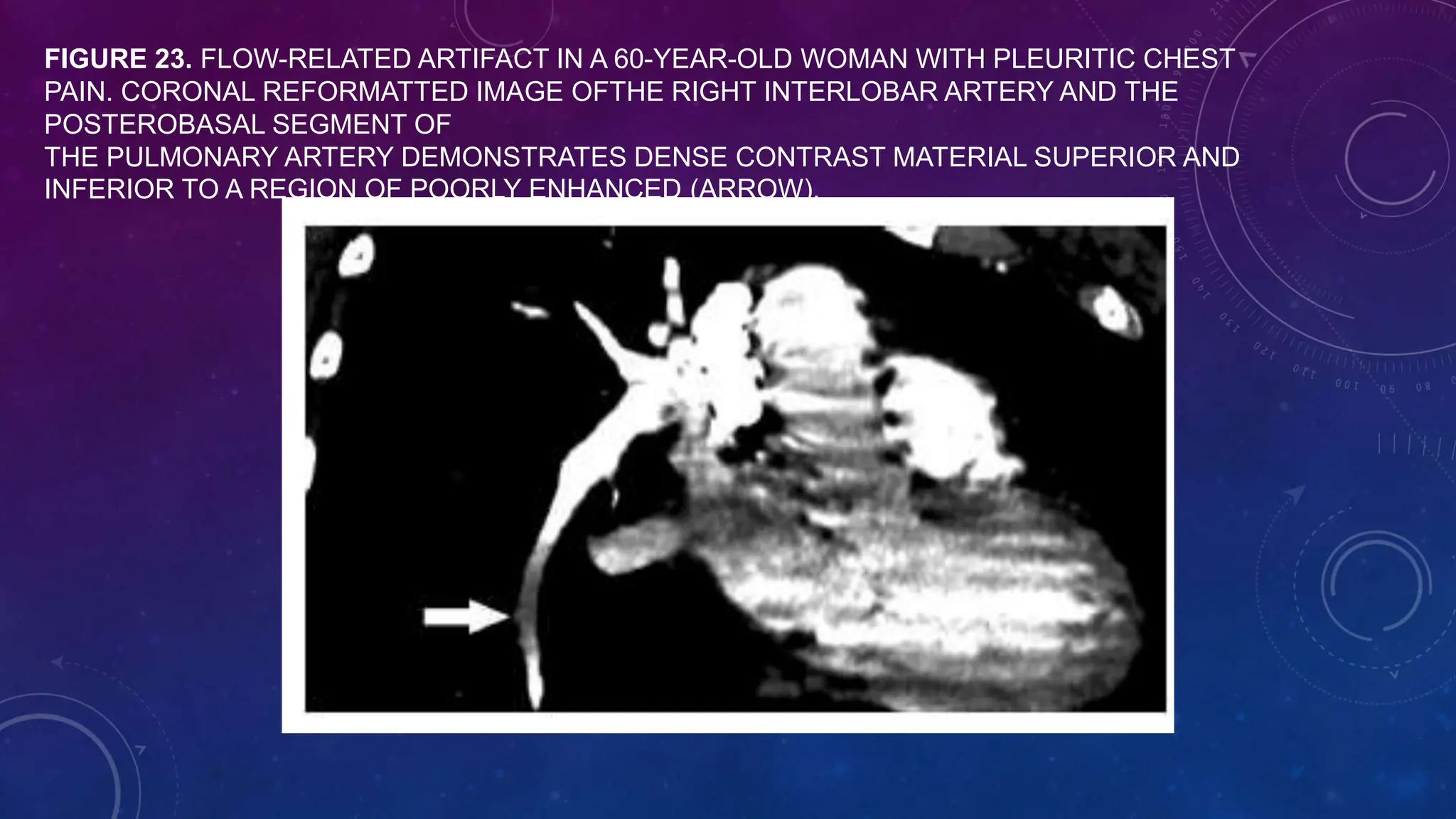 CT AnGIOGRAPHY of pulmonary embolism.pptx