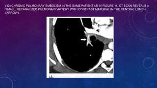 CT AnGIOGRAPHY of pulmonary embolism.pptx