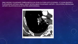 CT AnGIOGRAPHY of pulmonary embolism.pptx