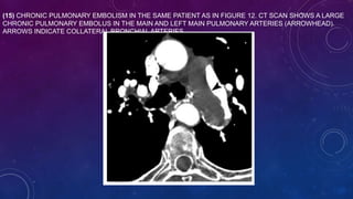 CT AnGIOGRAPHY of pulmonary embolism.pptx
